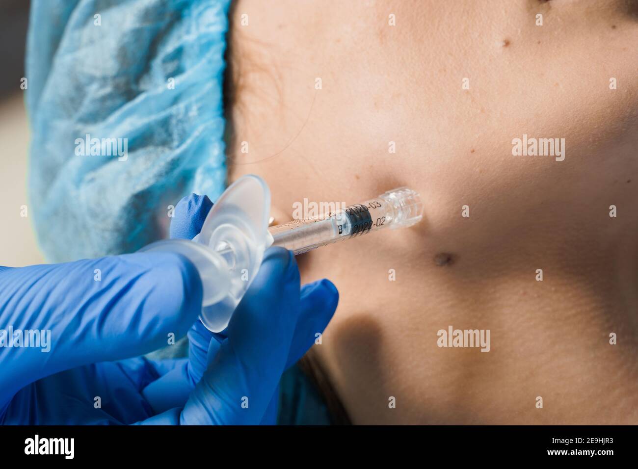 Filler injection of hyaluronic acid. Contour plastic for correcting the ...