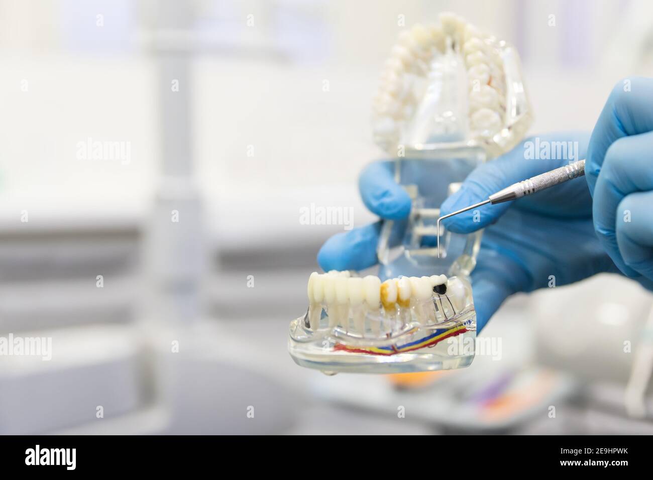 Closeup of dentist holding teeth model denture, showing what pulpitis ...