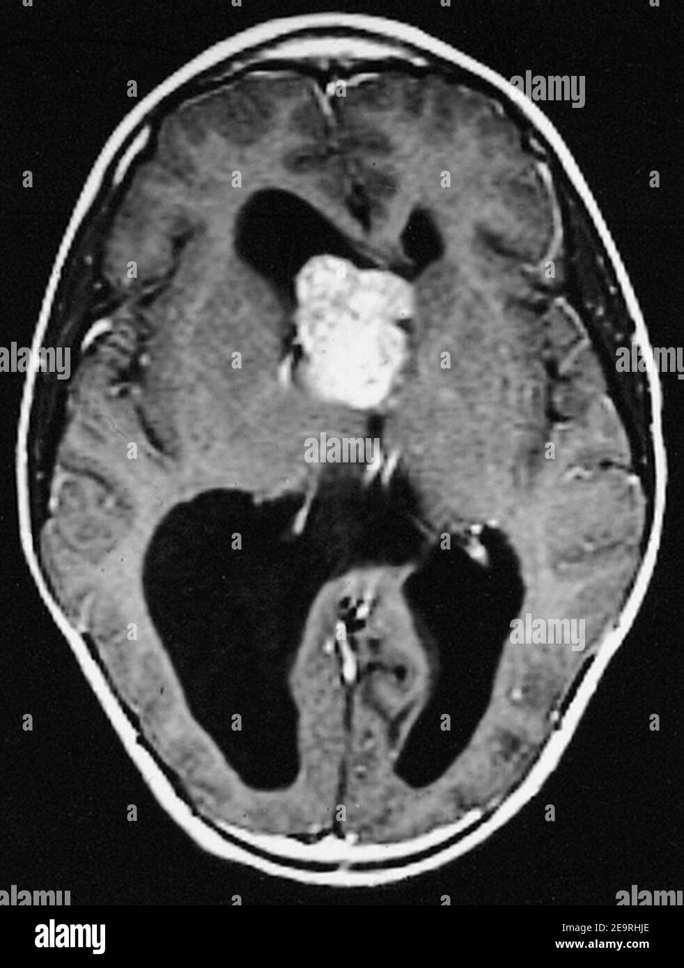MRI of brain with sub-ependymal giant cell astrocytoma Stock Photo - Alamy