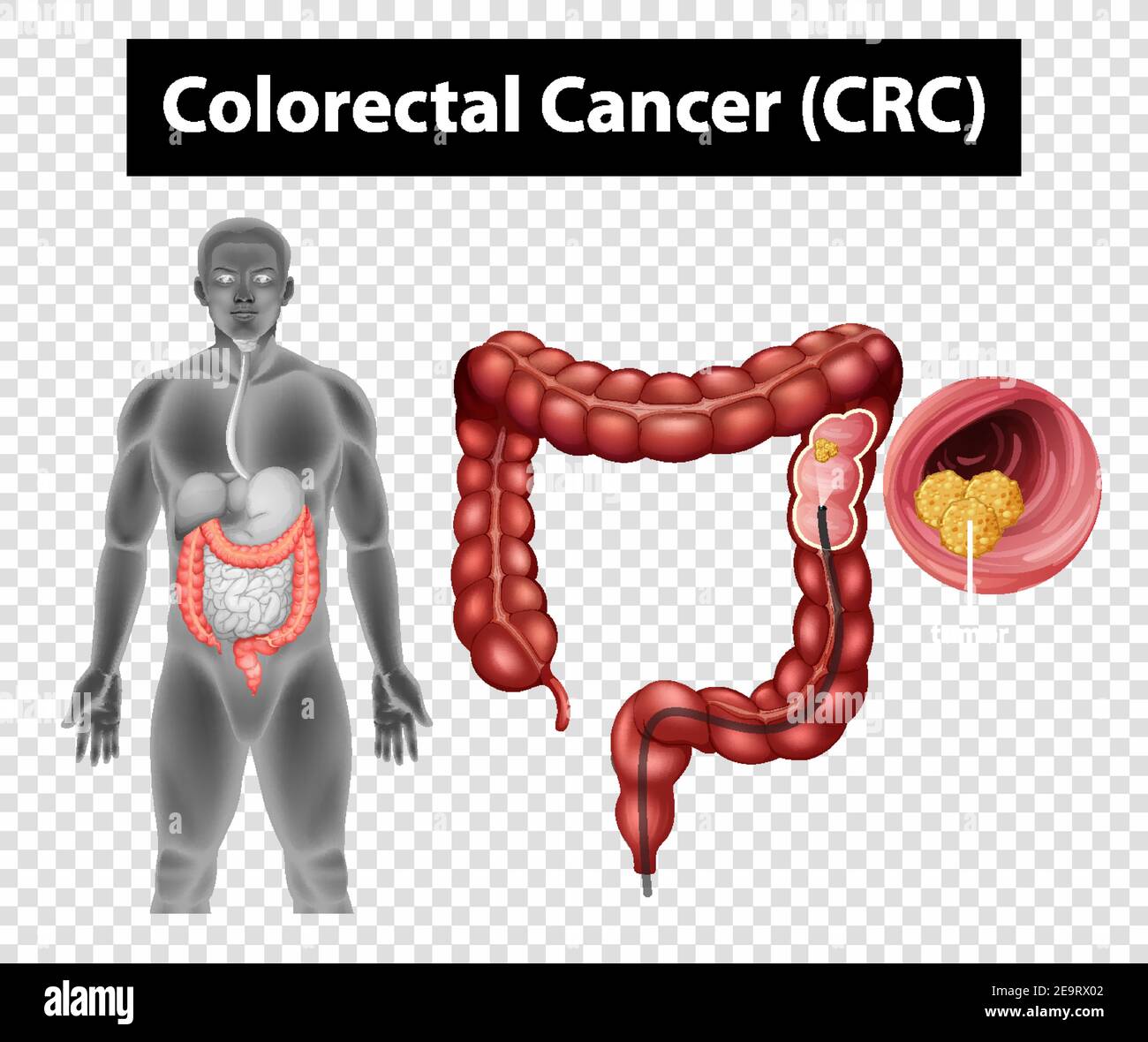 Diagram showing Colorectal Cancer (CRC) on transparent background ...