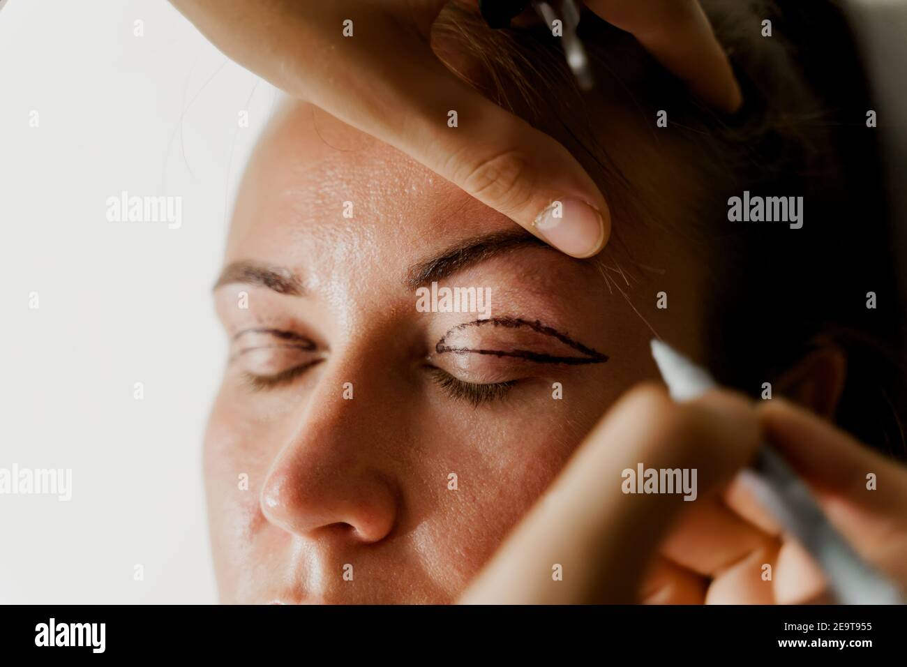 Blepharoplasty markup close-up on the face before the plastic surgery ...