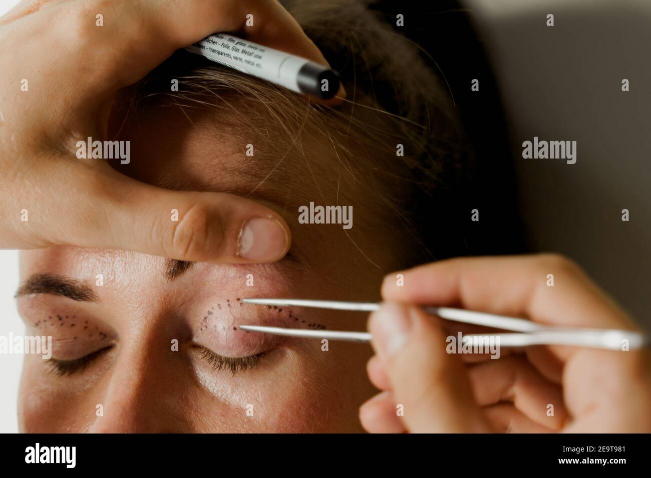 Blepharoplasty markup close-up on the face before the plastic surgery ...