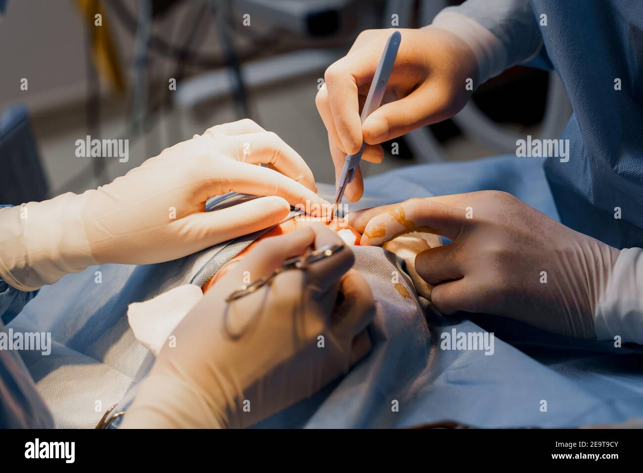 Blepharoplasty plastic surgery operation for modifying the eye region ...