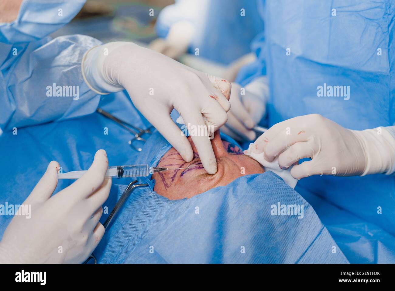Close-up anesthesia before blepharoplasty and lipofilling plastic ...
