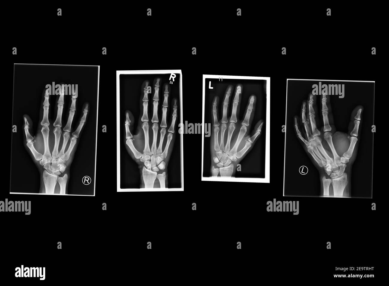 Illustration of the x-ray of left and right hands on a black background ...