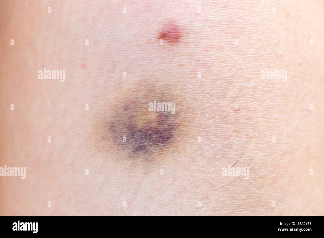 Closed up background of violet lesion on asian woman skin Stock Photo ...