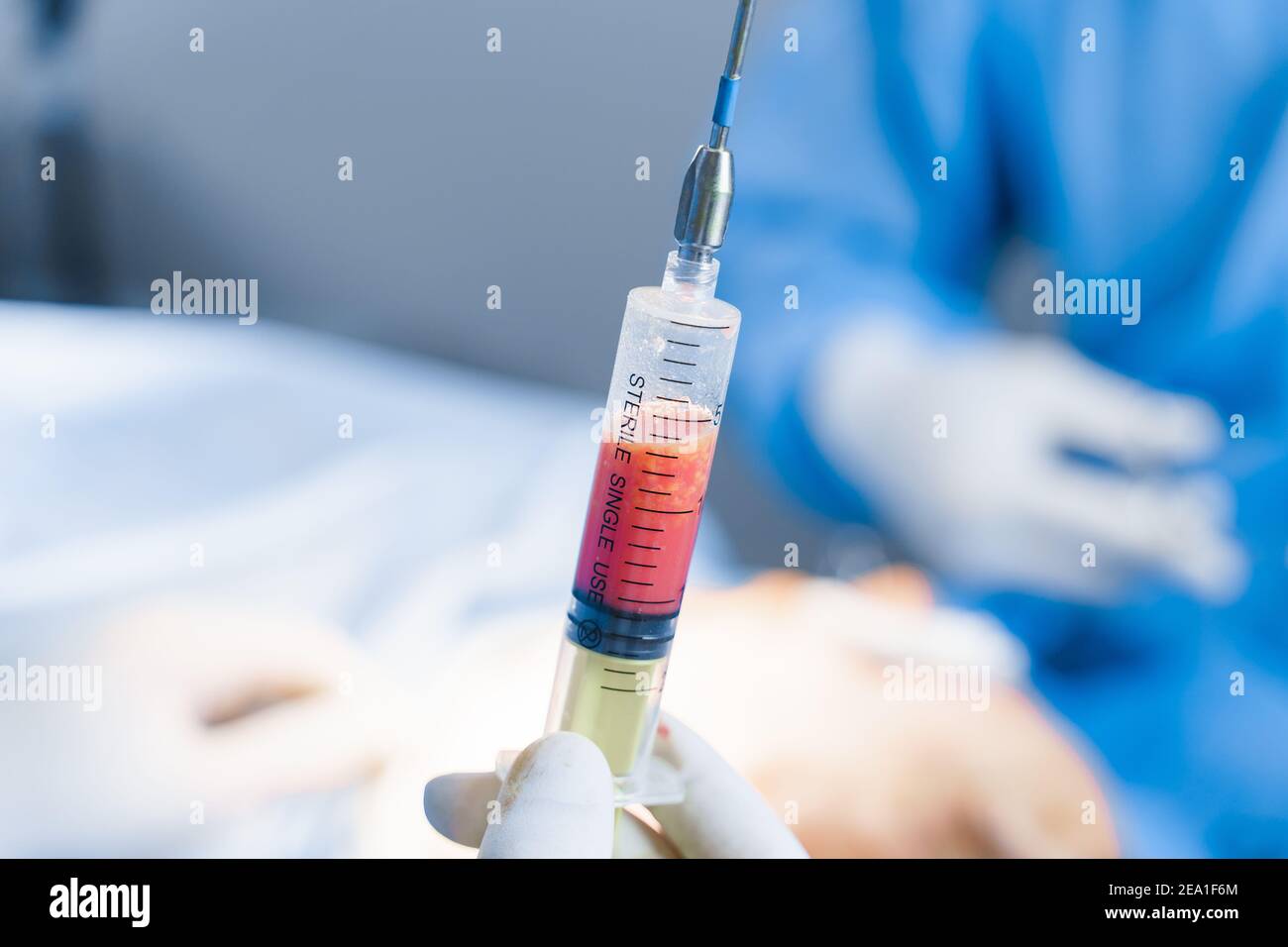 Human fat in a syringe close-up. Liposuction for lipofilling surgery ...