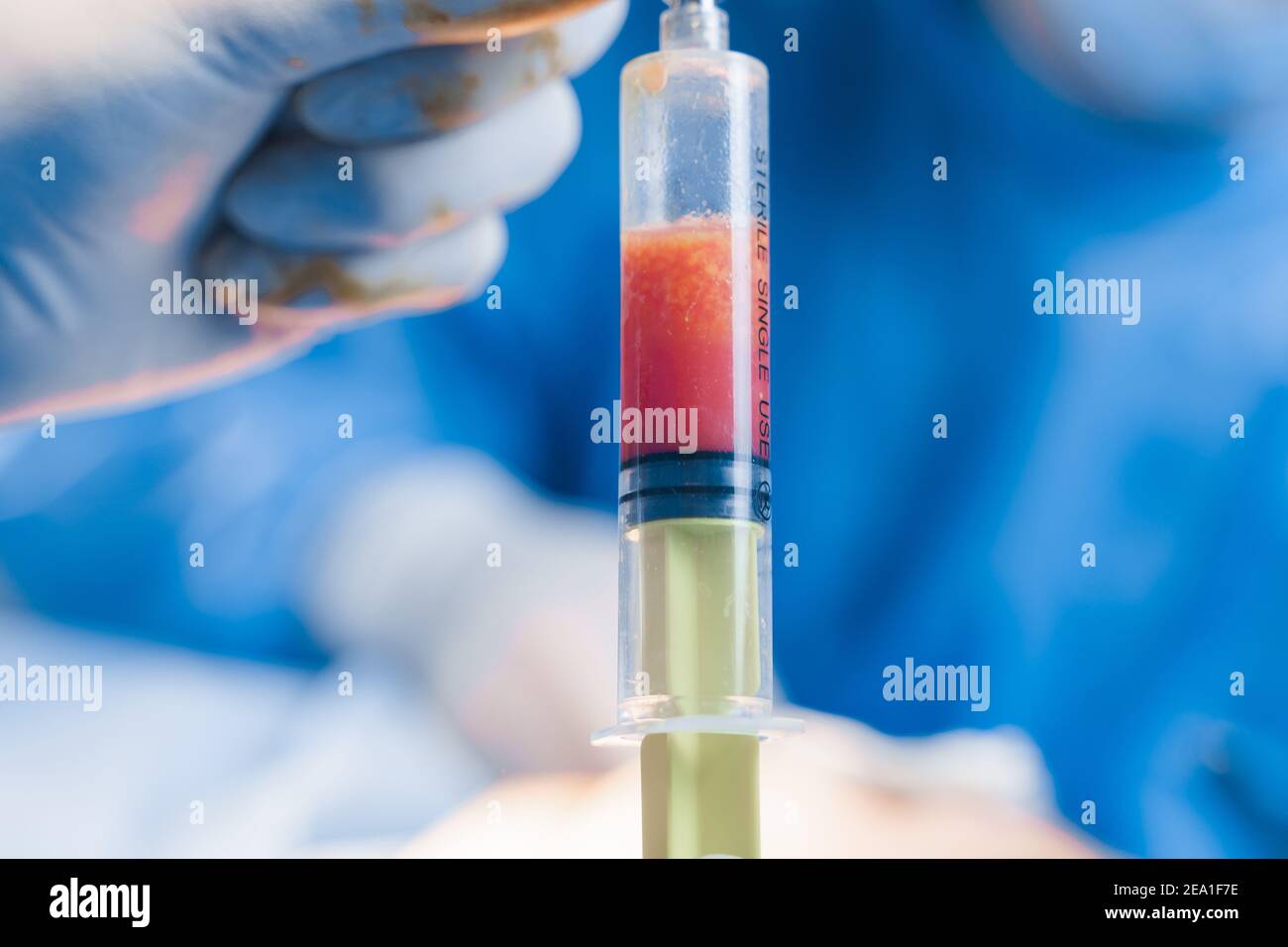 Human fat in a syringe close-up. Liposuction for lipofilling surgery ...
