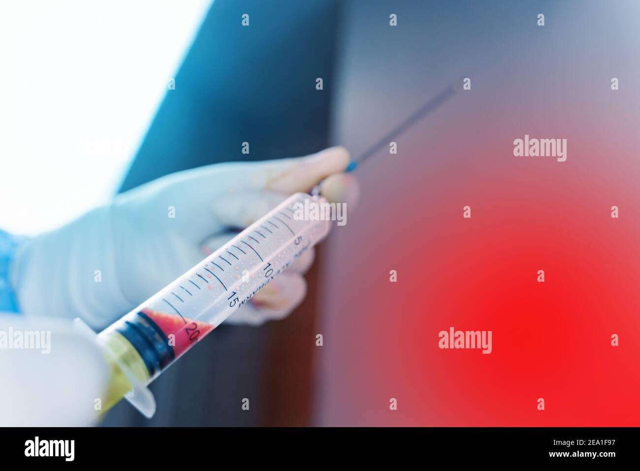 Human fat in a syringe close-up. Liposuction for lipofilling surgery ...