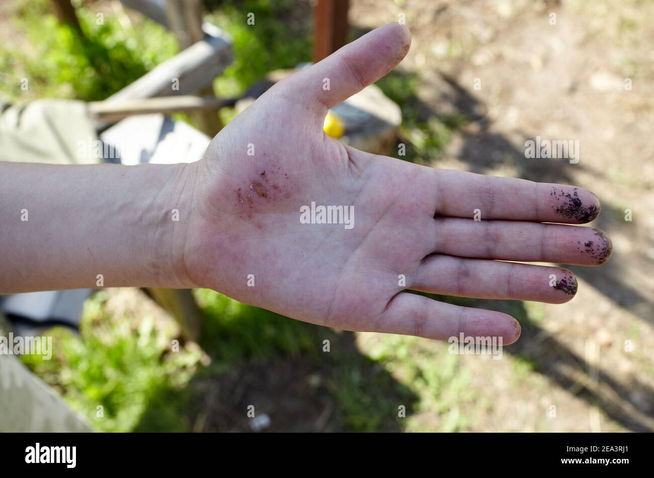 Hand injury hi-res stock photography and images - Alamy