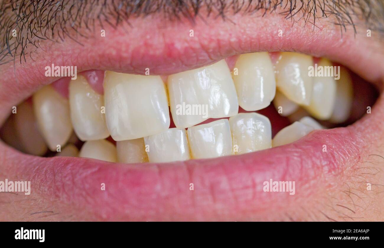 Uneven teeth hi-res stock photography and images - Alamy