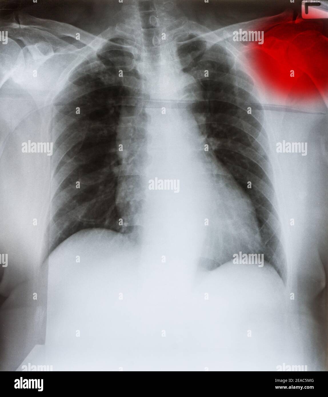 Chest x ray of patient with copd hi-res stock photography and images ...