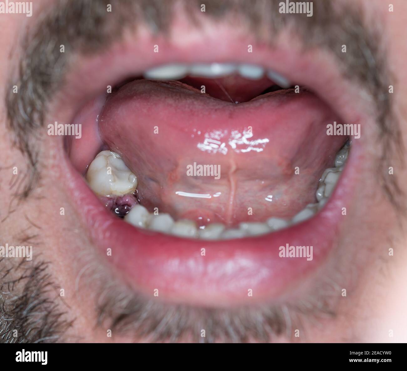 Wound tooth hi-res stock photography and images - Alamy