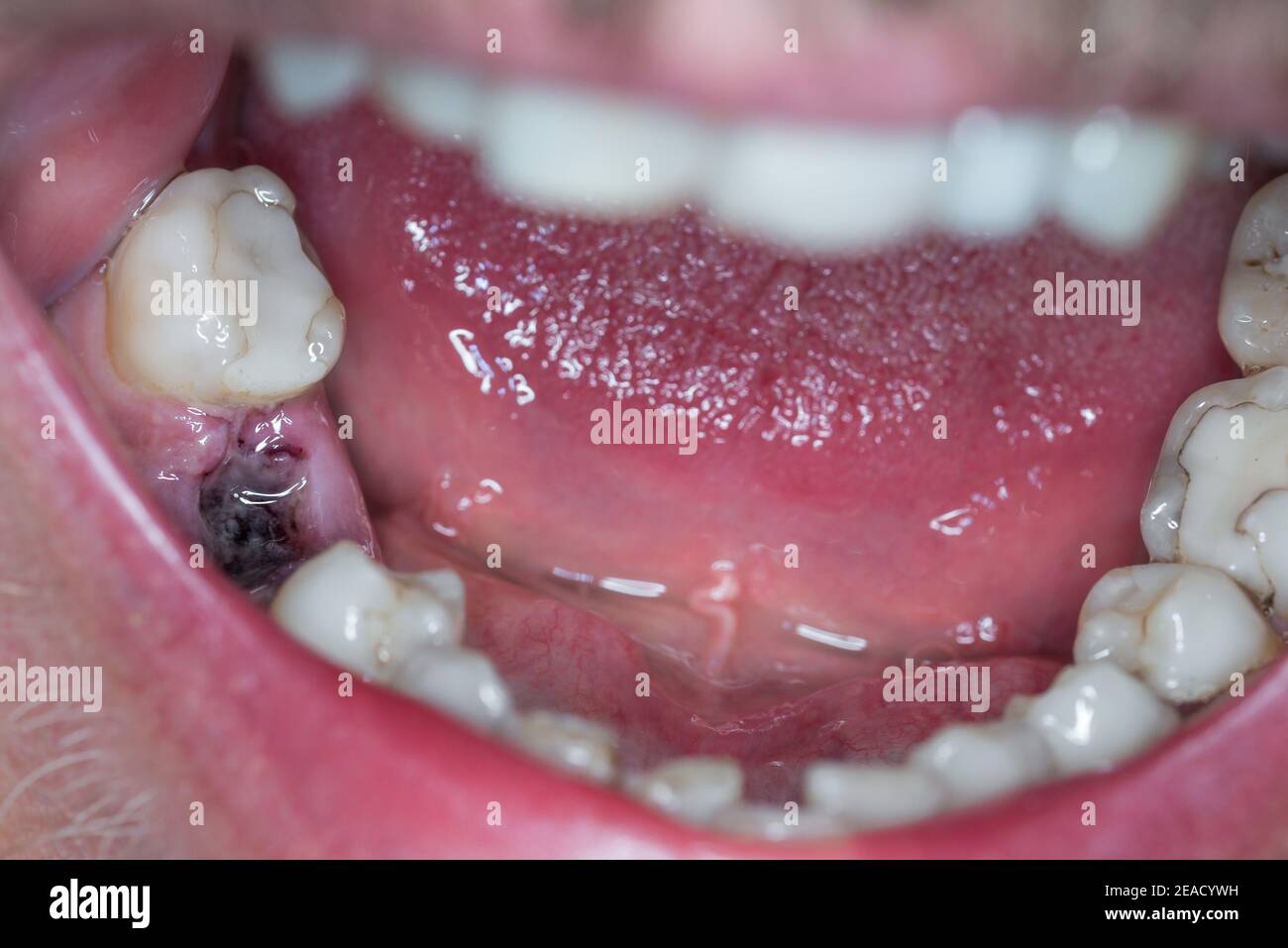 Wound tooth hi-res stock photography and images - Alamy