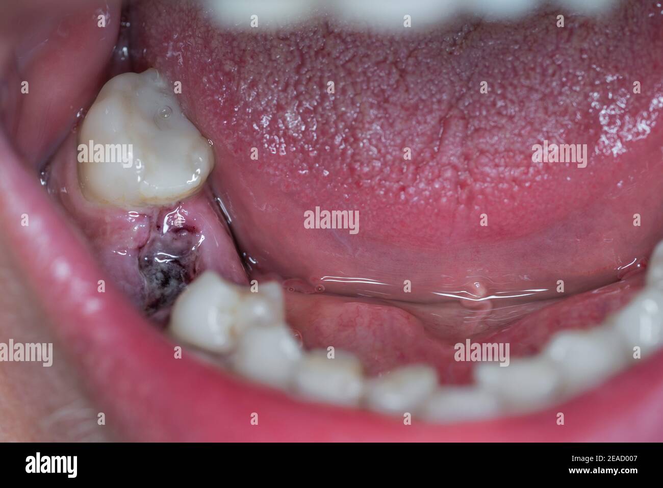 Teeth mouth fillings implant crown hi-res stock photography and images ...