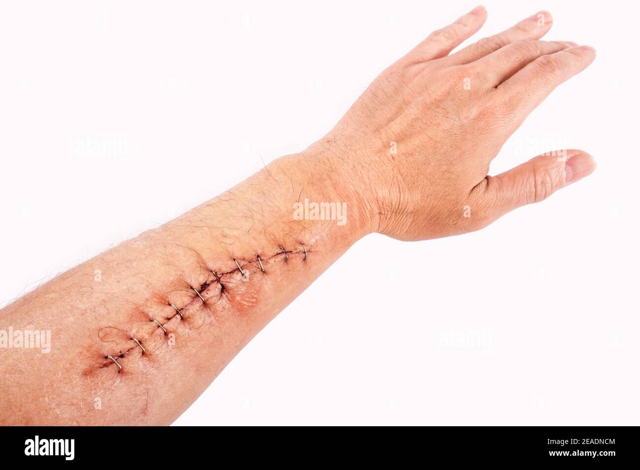 Surgery wound fix with staple on arm,isolated on white background Stock ...