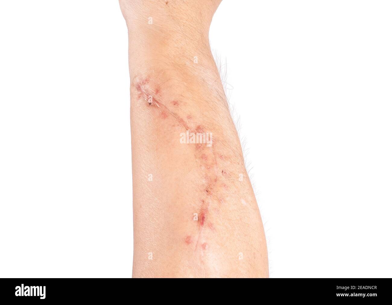 Surgical wound on the arm,isolated on white background Stock Photo - Alamy