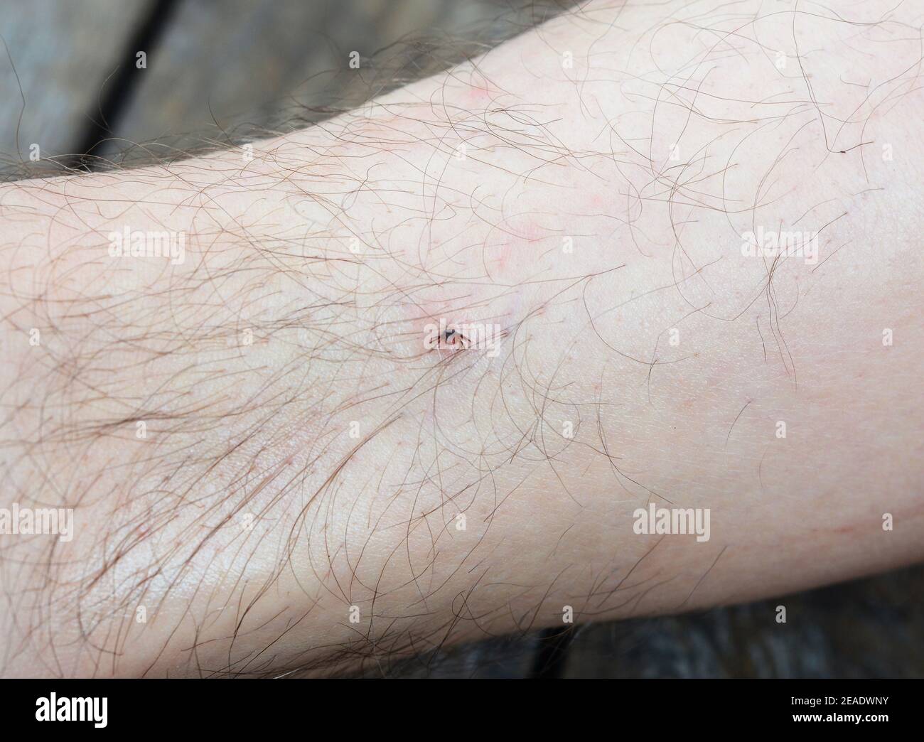 Deer tick on skin hi-res stock photography and images - Alamy