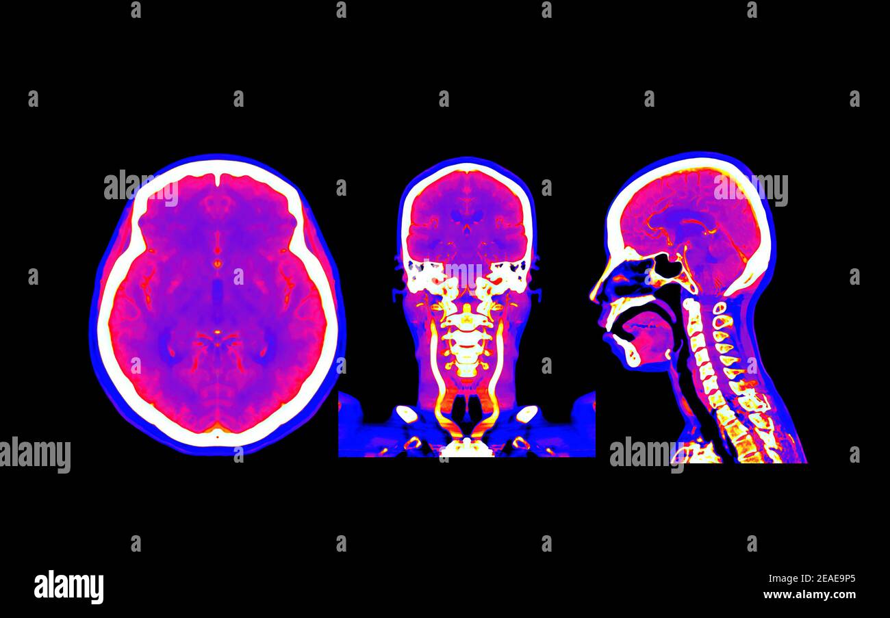 Collection colorful of CT angiography of the brain or CTA brain ...