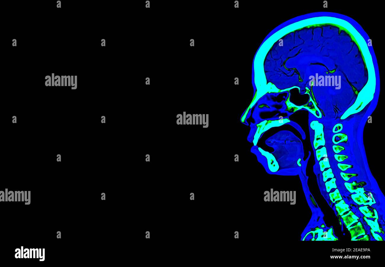 colorful of CT angiography of the brain or CTA brain Sagittal view ...