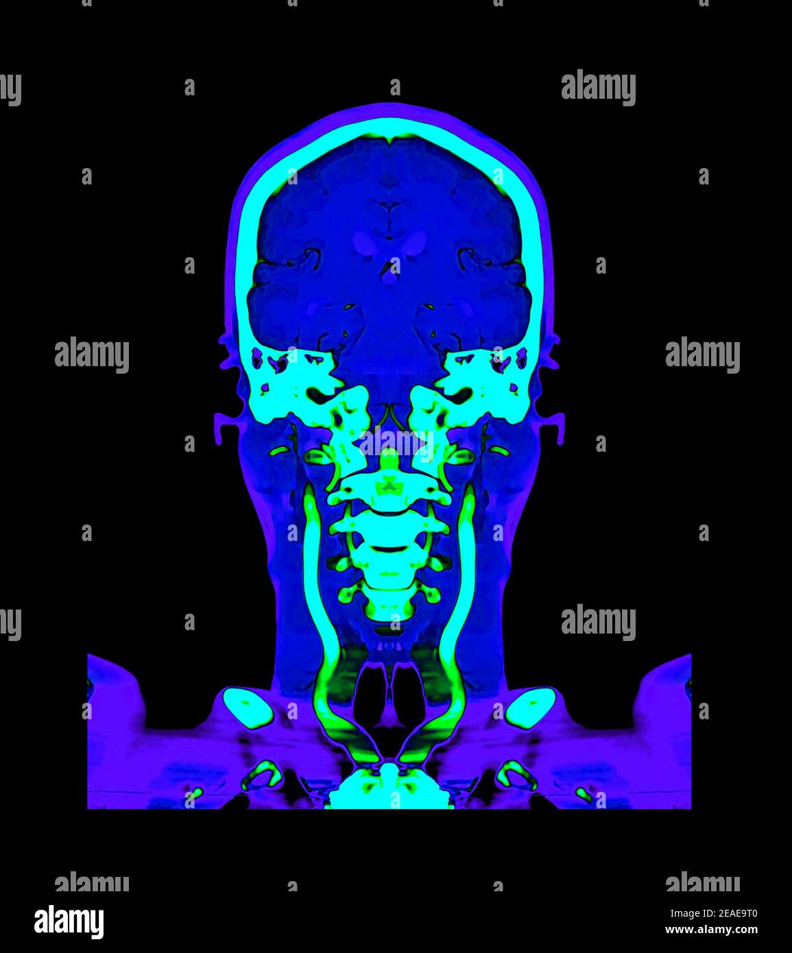 Collection colorful of CT angiography of the brain or CTA brain ...
