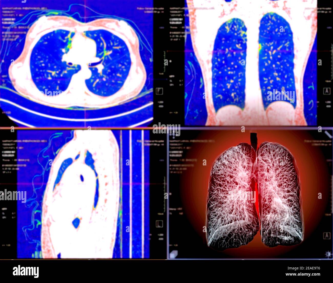 Selective focus of CT Chest or Lung 3D rendering image on the monitor ...