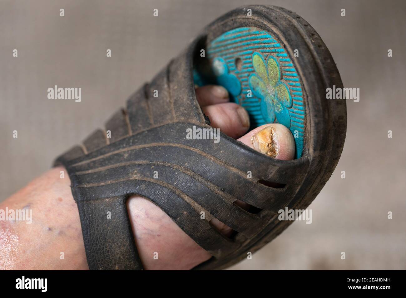 Picture of a dermatomycosis and onychomycosis, fungal infection Stock ...