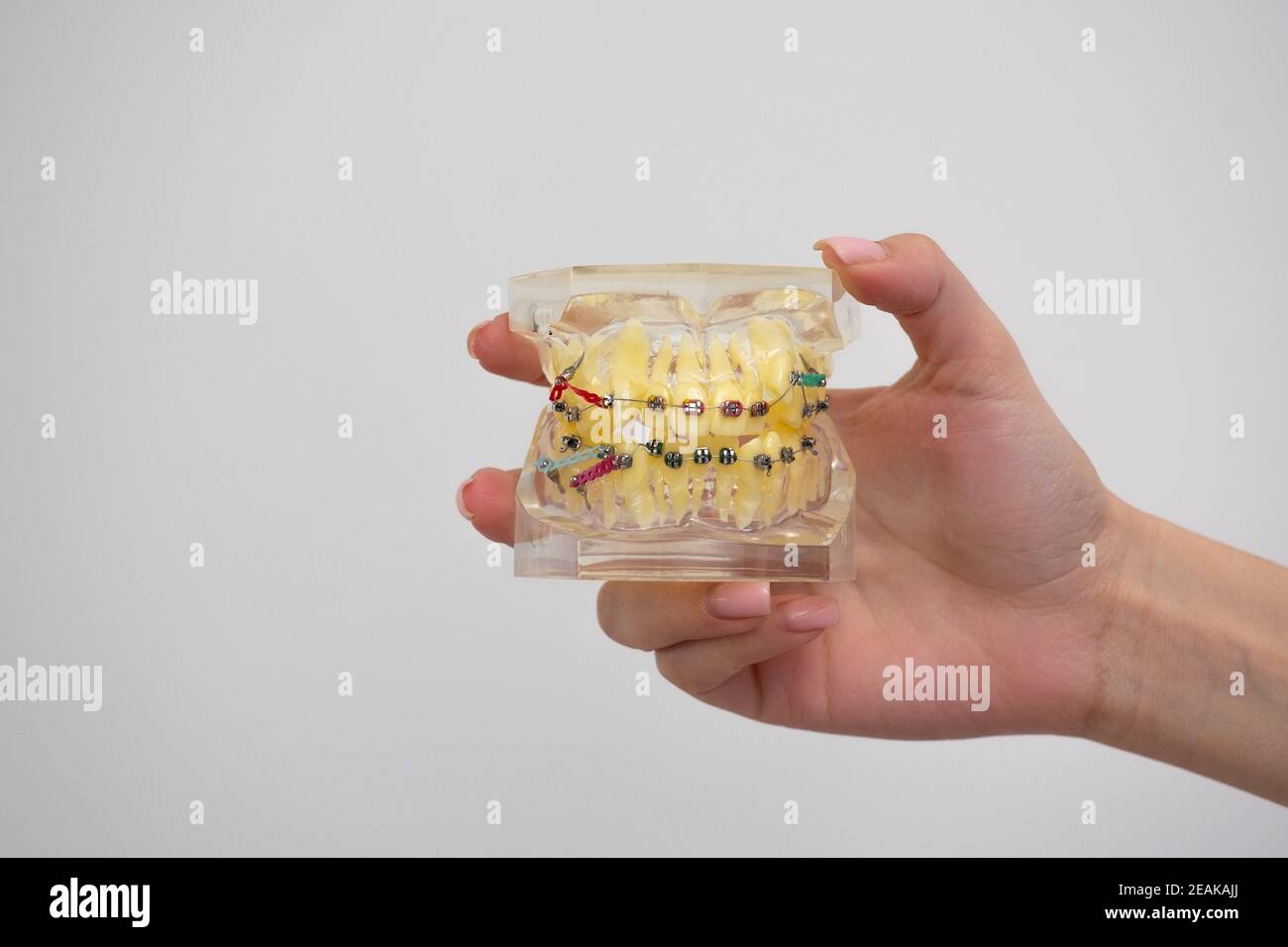 Typodont with braces, dental treatment abnormal occlusion Stock Photo ...