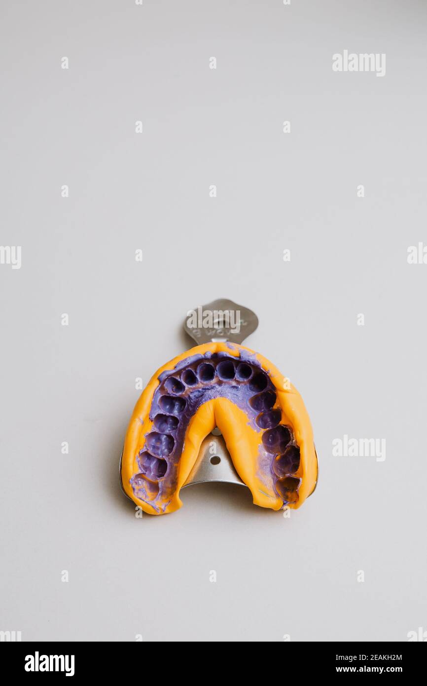 The dental impression is filled with a patch, creating a prosthetic ...