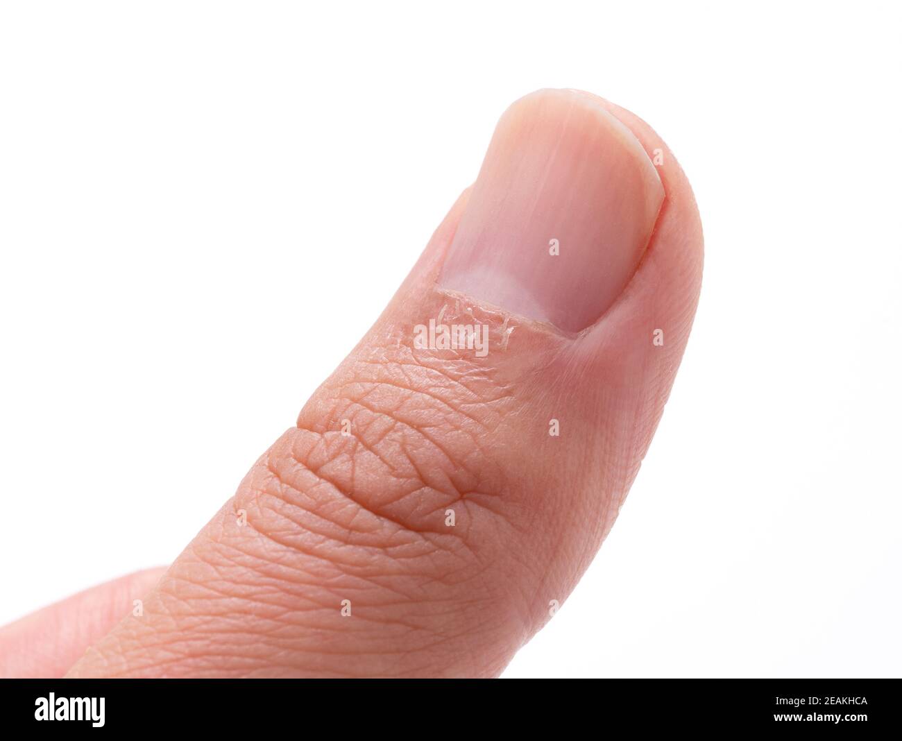 A close-up of a hangnail on a white background Stock Photo - Alamy