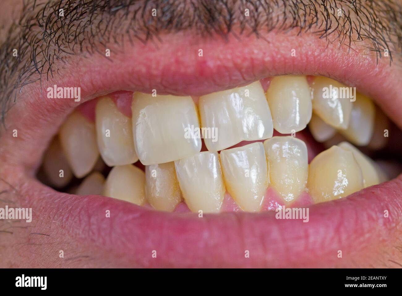 Uneven teeth hi-res stock photography and images - Alamy