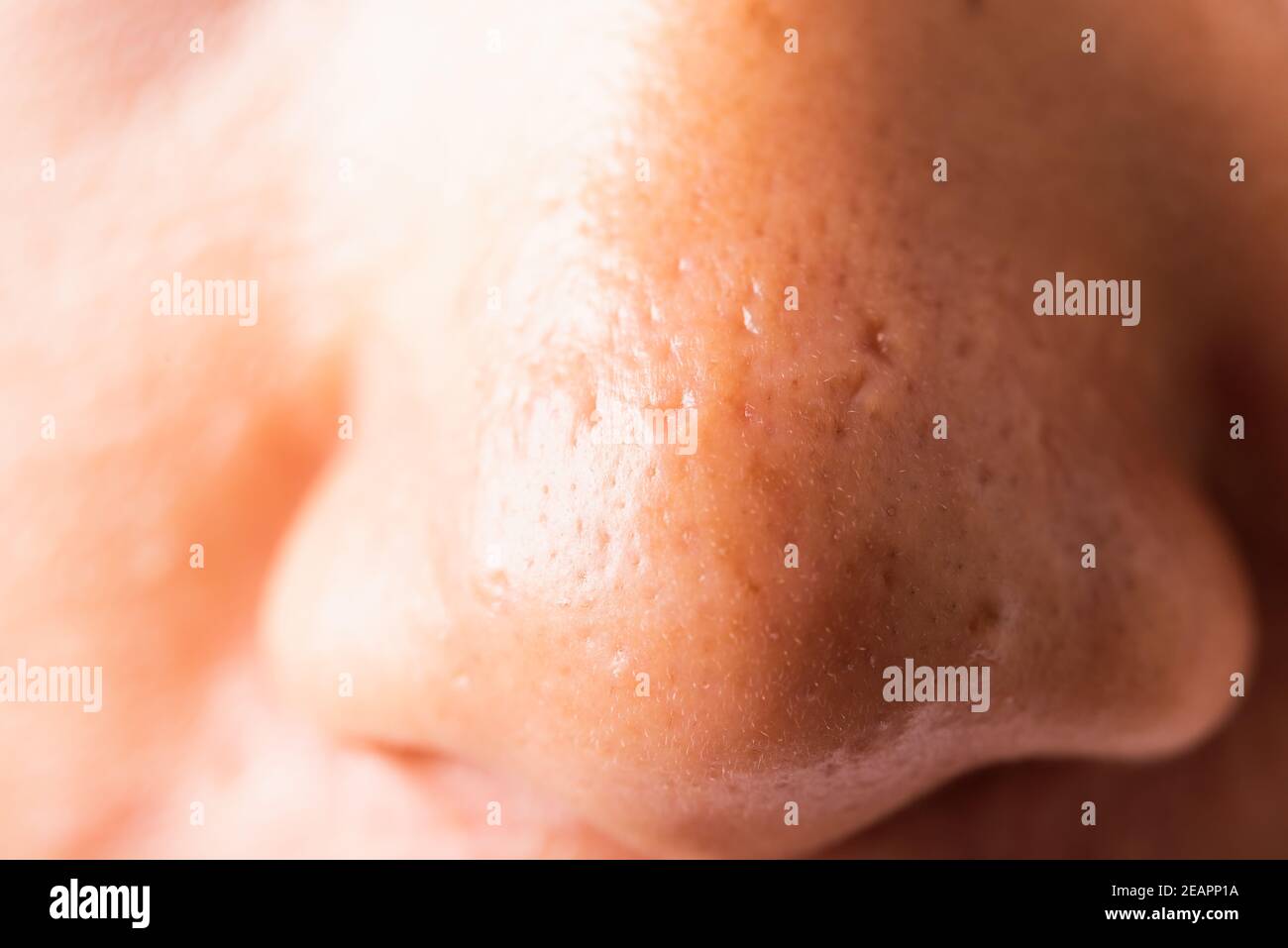 Woman large pores have freckles cheek oily, acne pimple on nose Stock ...