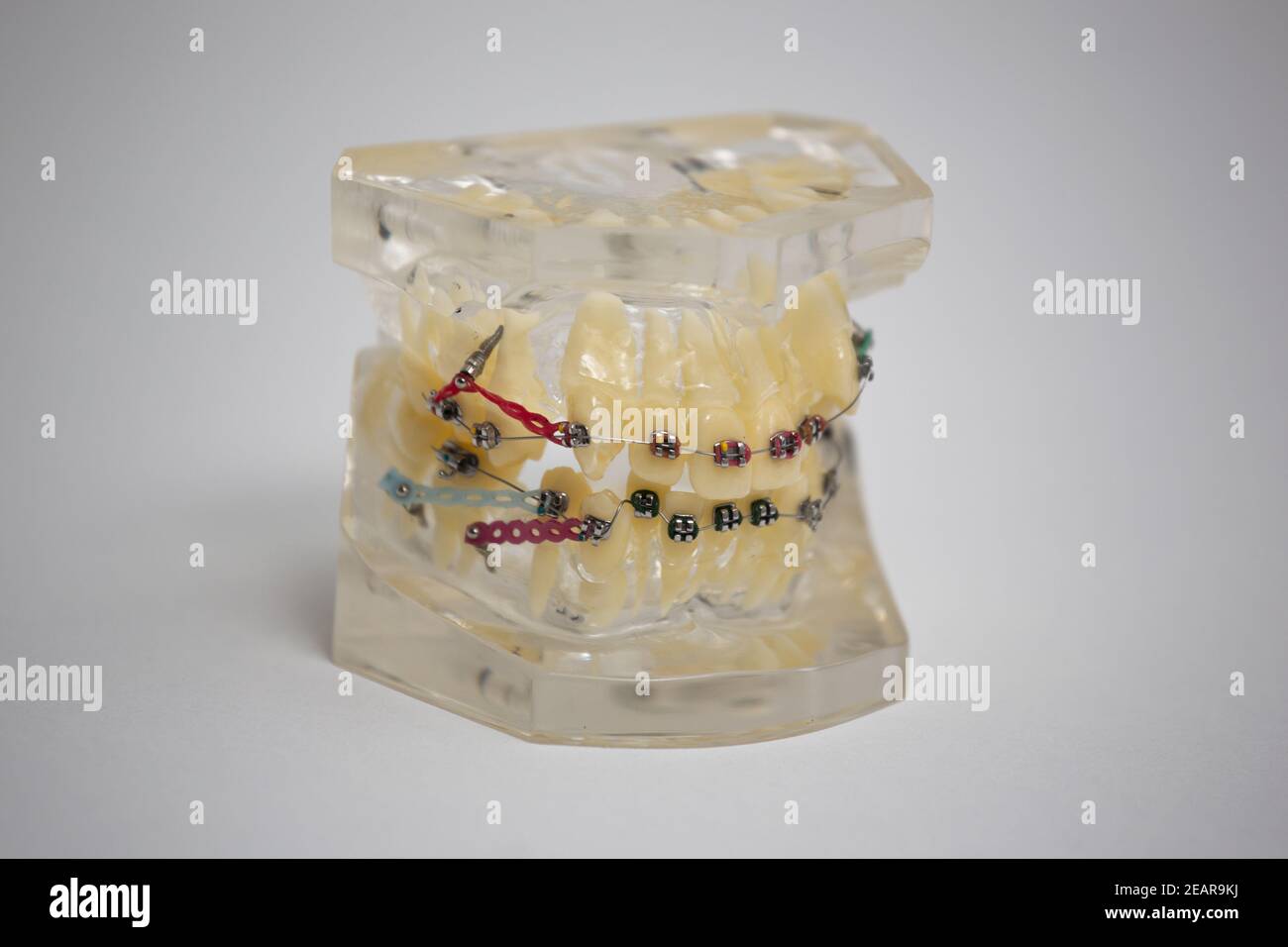 Typodont with braces, dental treatment abnormal occlusion Stock Photo ...