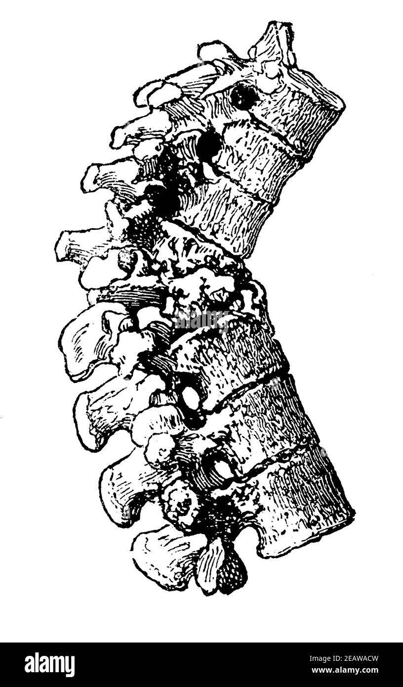Tuberculosis of the spine bones, close-up. Illustration of the 19th ...