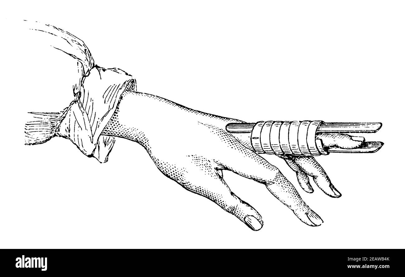 Finger fracture fixation (splint). Illustration of the 19th century ...
