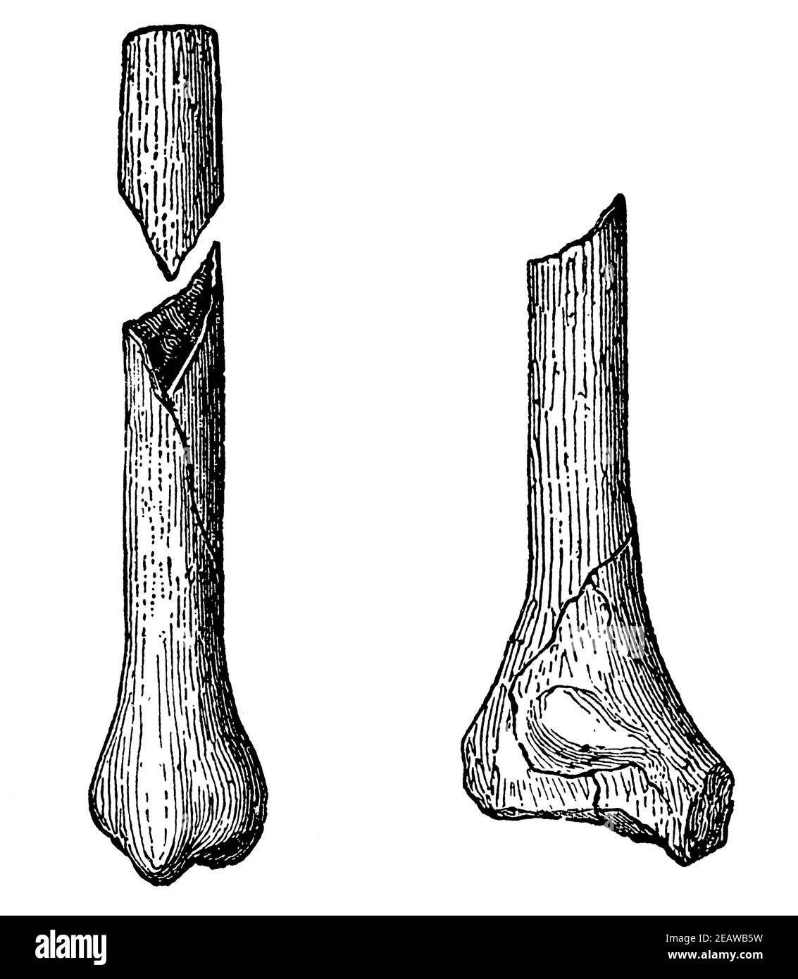 V-shaped fracture of the lower part of the tibia. Illustration of the ...