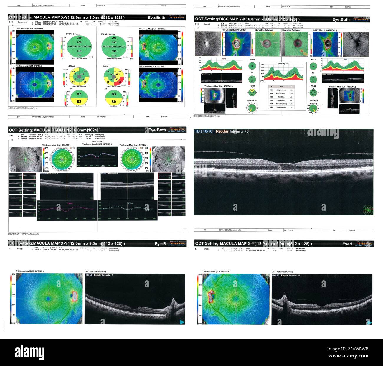 Eye test scans shown on a computer screen Stock Photo - Alamy
