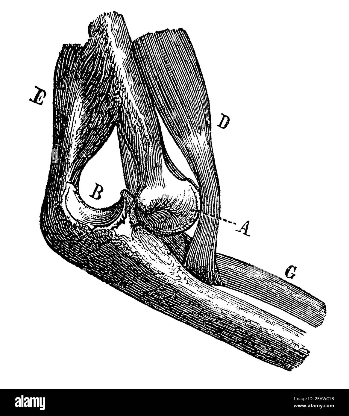 Dislocation of the elbow joint. Illustration of the 19th century ...
