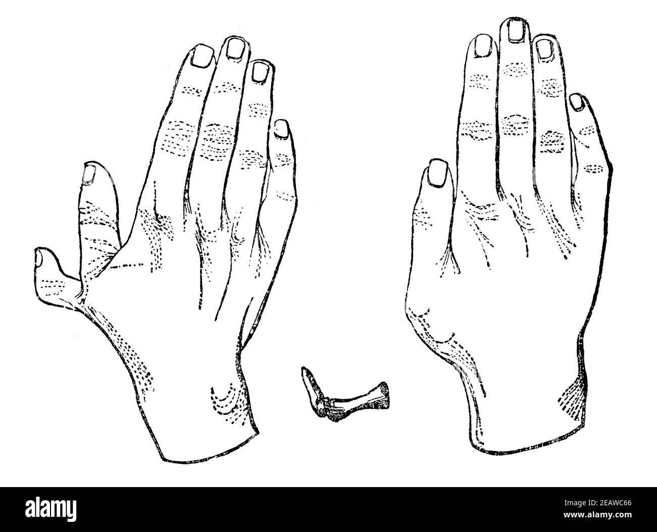 Preaxial polydactyly. Illustration of the 19th century. Germany. White ...