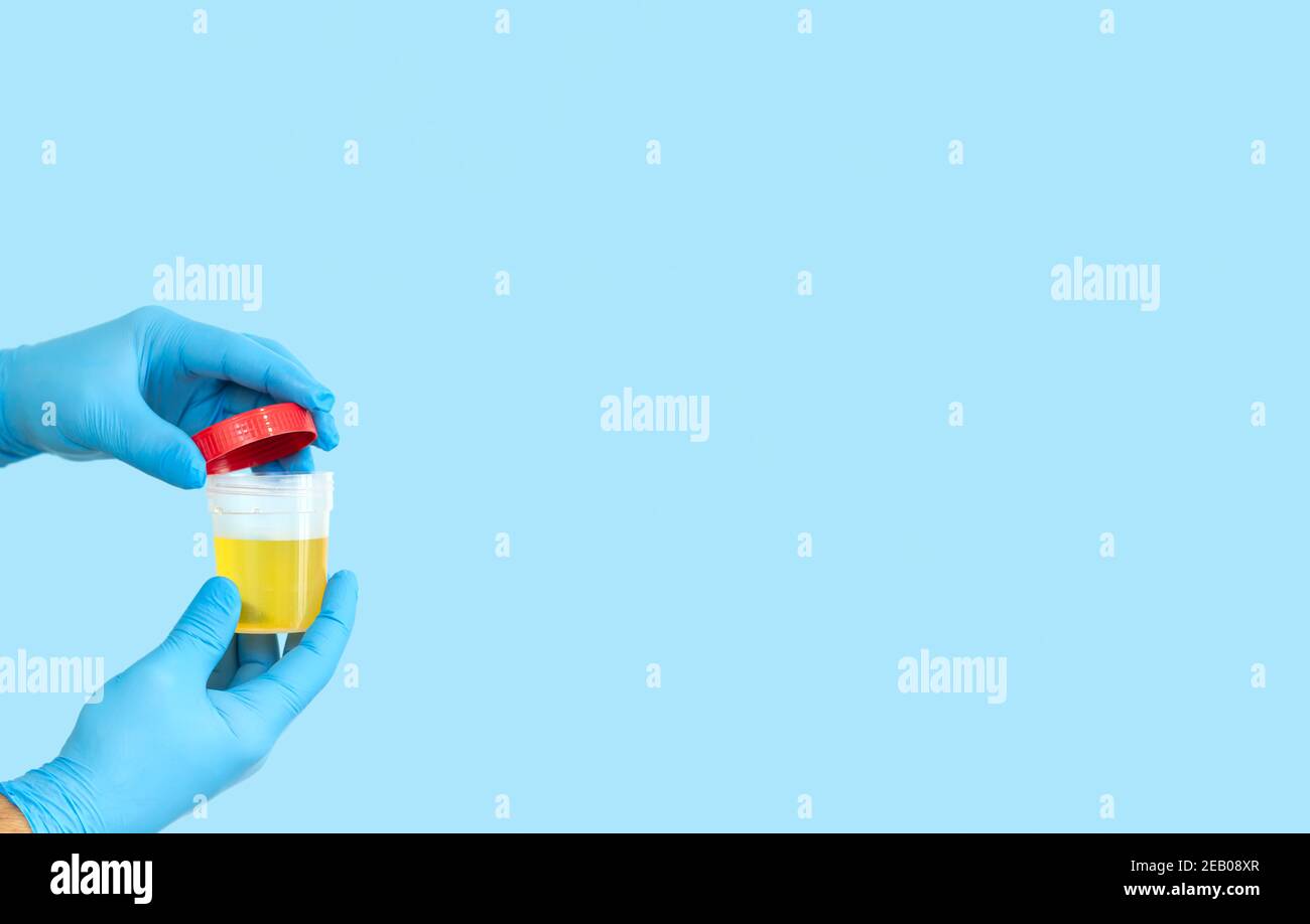 Medical worker holding open urine sample container for medical ...