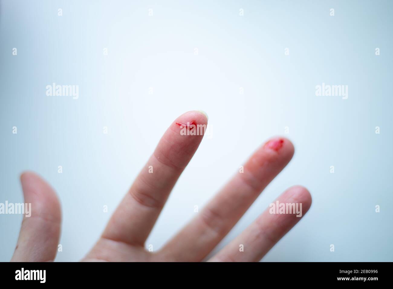 Cut finger hospital hi-res stock photography and images - Alamy