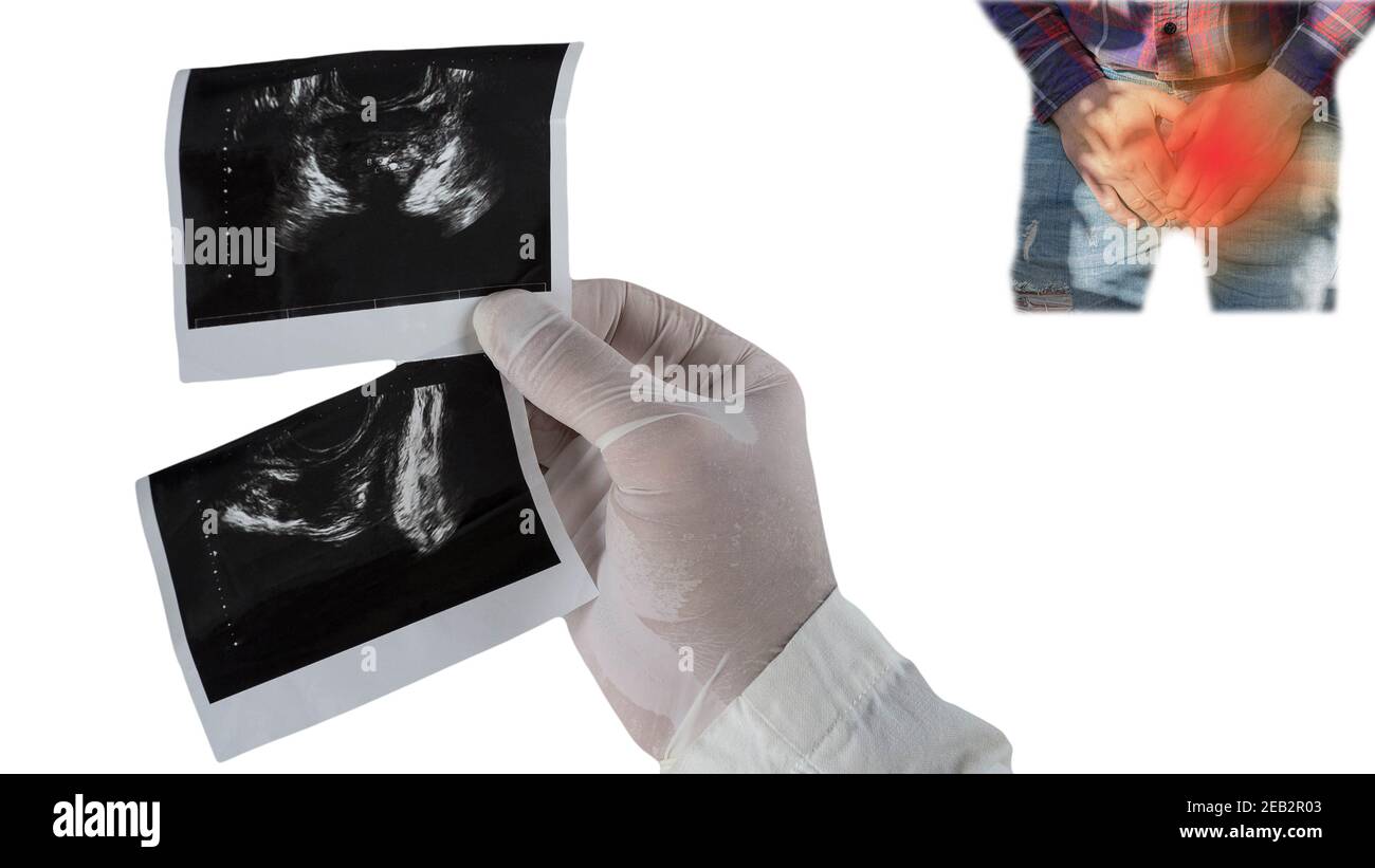 Prostate adenoma in men on ultrasound scan isolated on white copy space ...