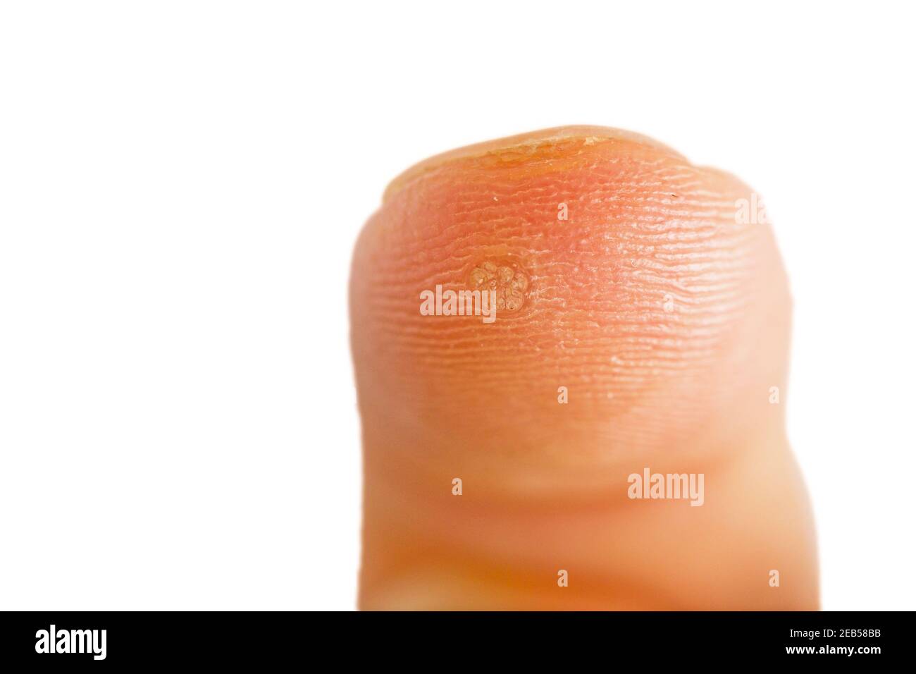 verruca formation over white background Stock Photo - Alamy