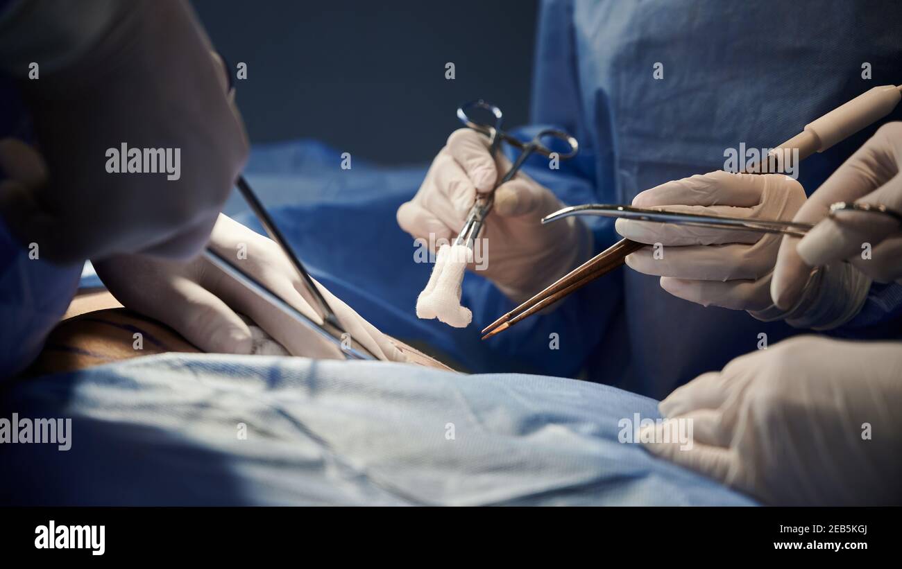 Surgical team in blue suits using medical instruments and performing ...
