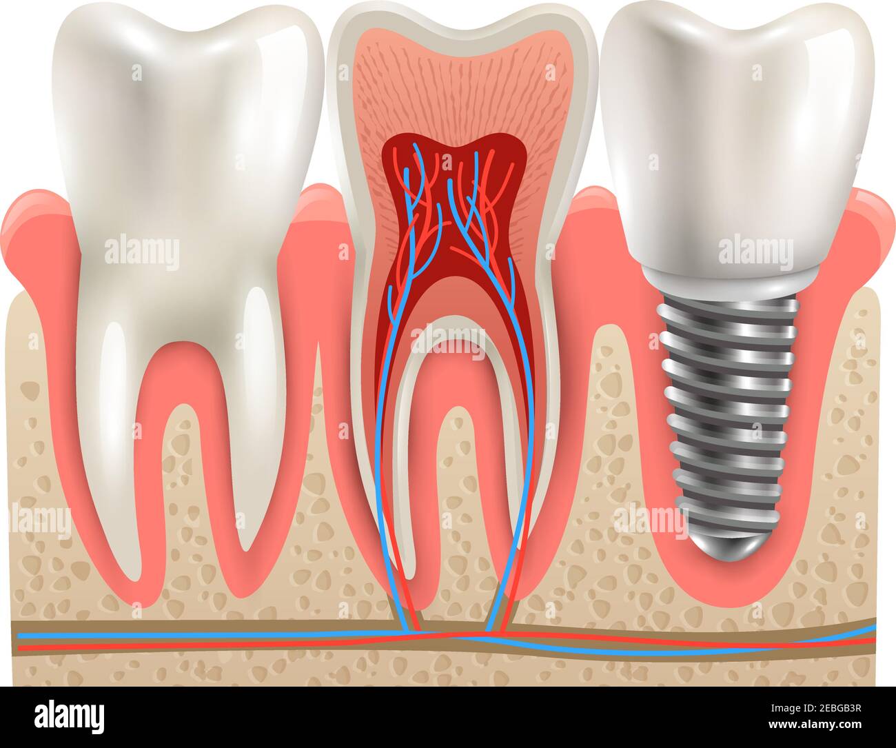 Dental implant and real tooth anatomy closeup cut away section model ...