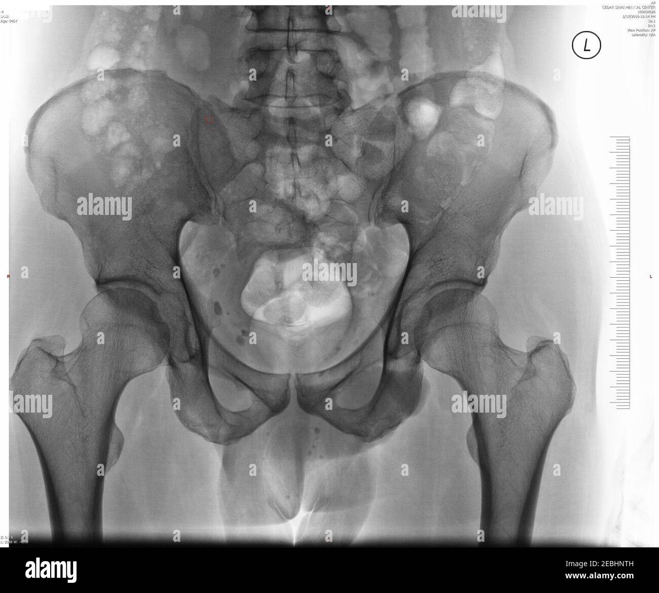 Human pelvis hi-res stock photography and images - Alamy
