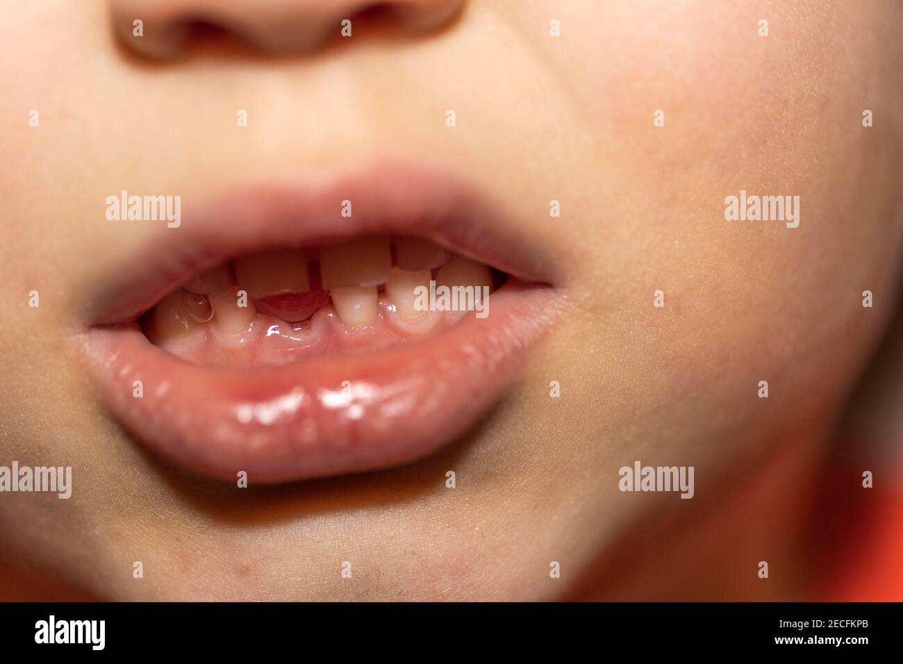 Lost tooth hi-res stock photography and images - Alamy