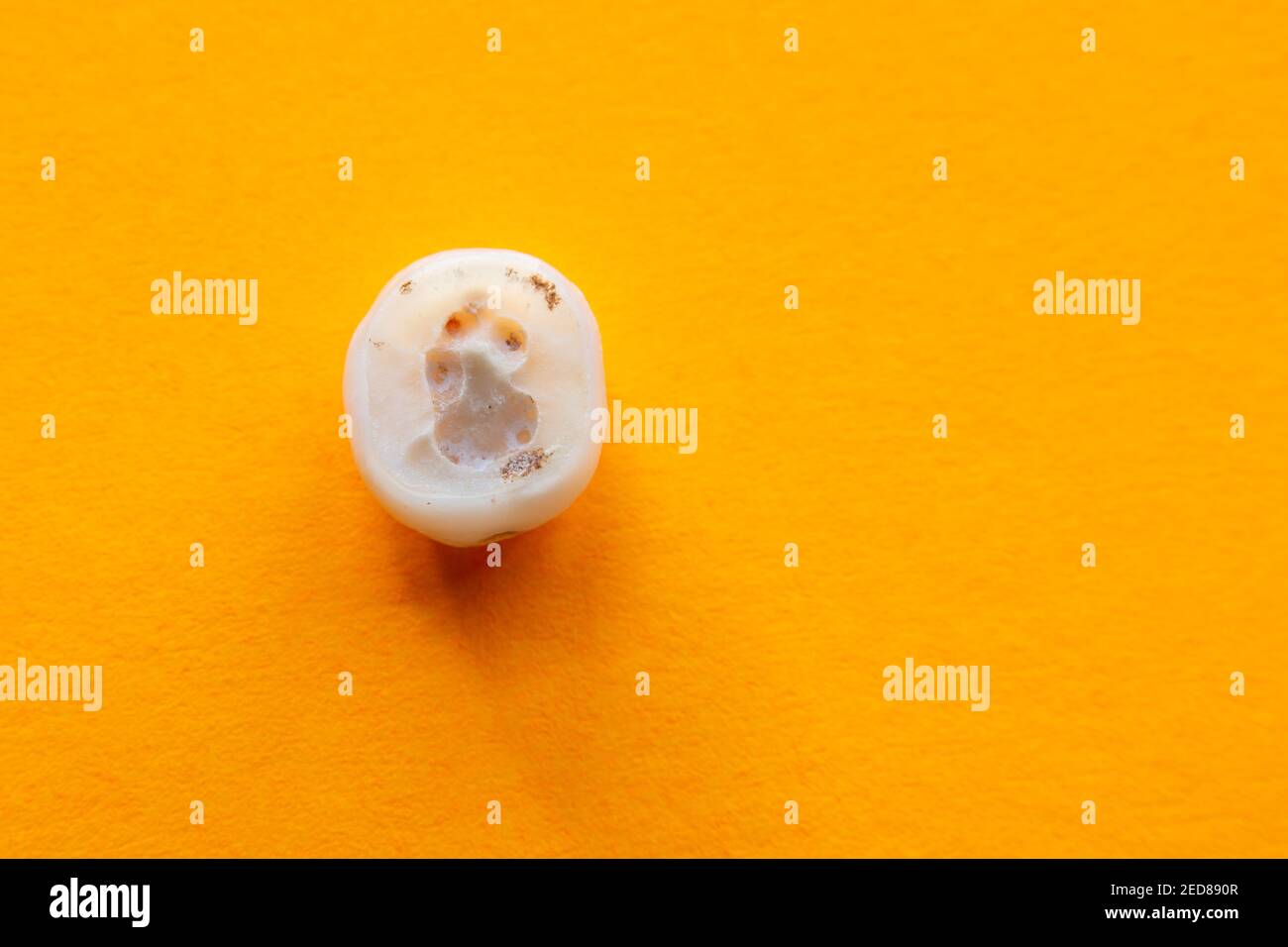 Human tooth root affected by caries, close-up on yellow background ...