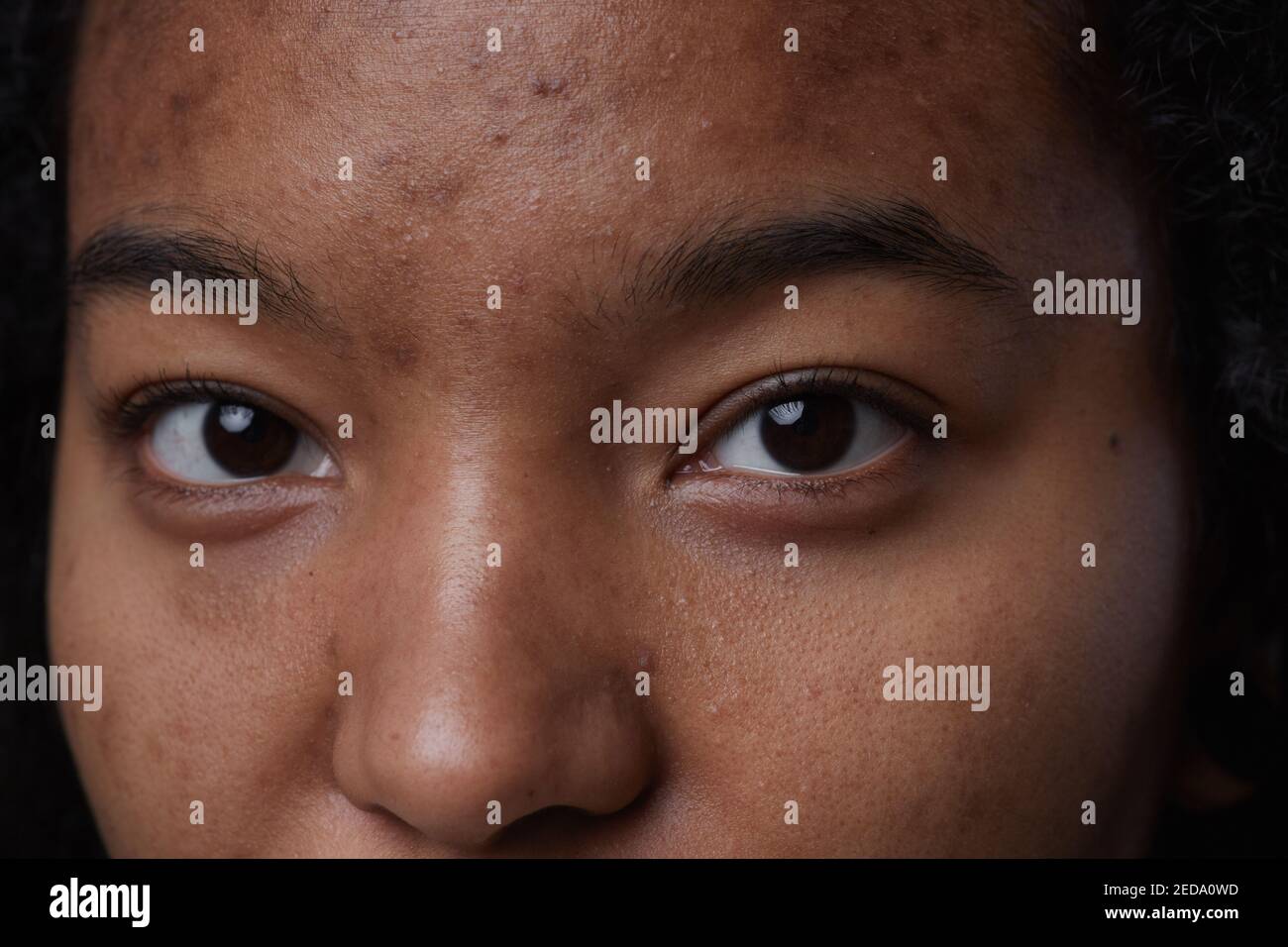 Imperfect skin hi-res stock photography and images - Alamy