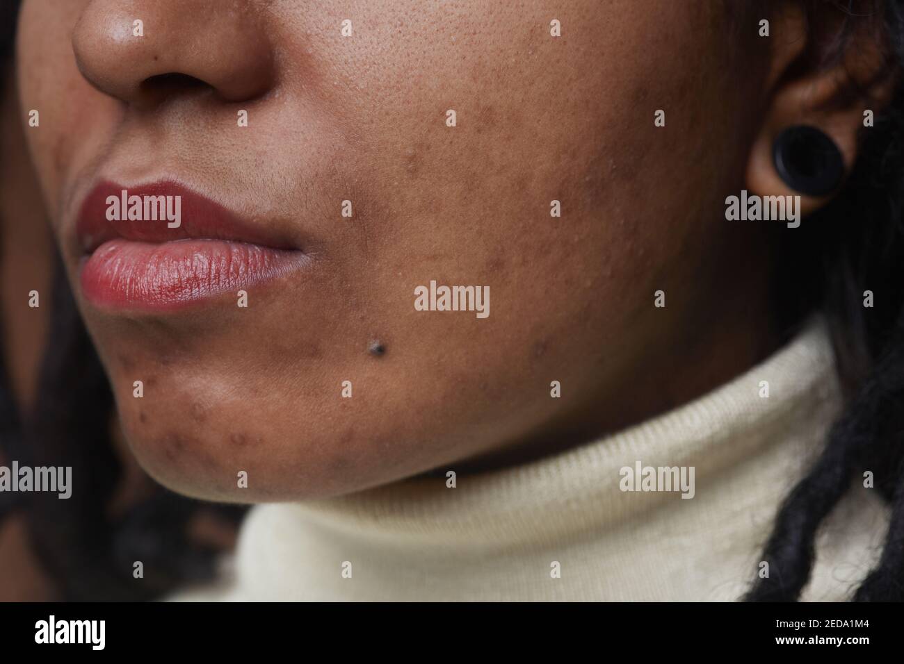 Extreme close up portrait of real African American woman with post acne ...